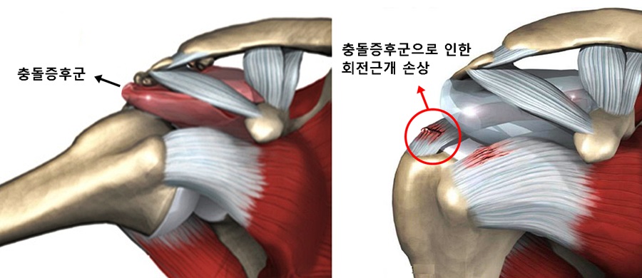 겨울철 어깨 통증 충돌 증후군 청주 정형외과 네이버 블로그